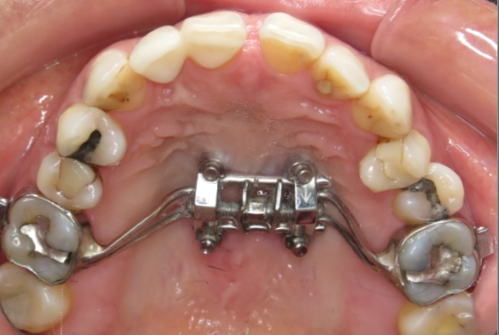 Orthodontic Mse At Susan Burke Blog